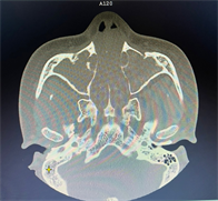 Ethmoidal Polyposis, Adenoid Hypertrophy and Tympanic Membrane ...