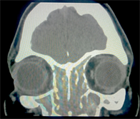 Ethmoidal Polyposis, Adenoid Hypertrophy and Tympanic Membrane ...
