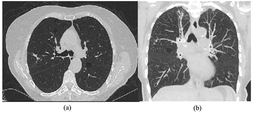 Lady Windermere Syndrome: An Interesting Clinical and Radiological ...
