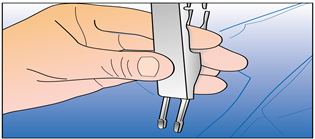 The Outpatient Burch-Sling Procedure: A Nerve-Sparing Method for ...