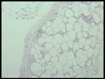 Erythema Nodosum Manifestation Post COVID-19 Vaccine: A Case Report