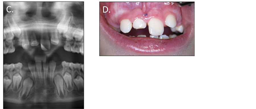 Two-Phase Transplantation (TPTX) Concept: A New Approach for Instant ...