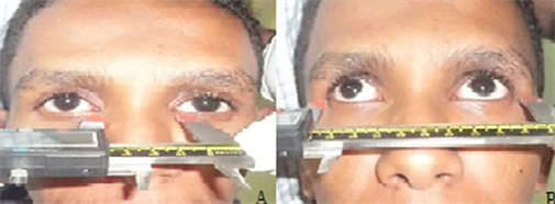 Ethnic Comparison of Inner and Outer Intercanthal Distance among Adult ...