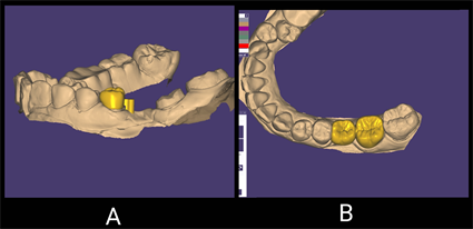 Managing Tilted Molar Abutment Using a Digitally Fabricated Split ...