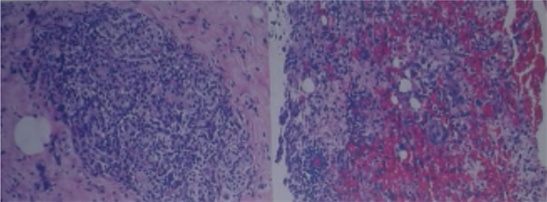 Granulomatous Mastitis, Radio-Histological Correlation
