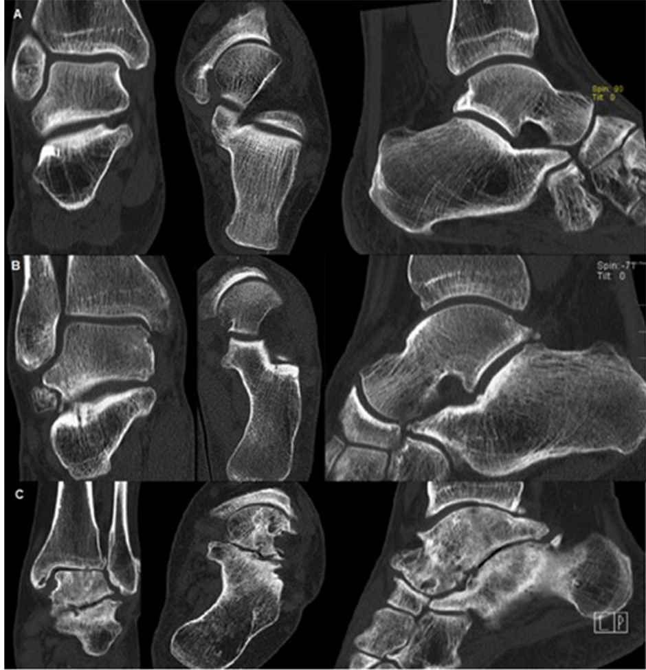 Subtalar Dislocation: Long-Term Follow-Up and CT-Morphology