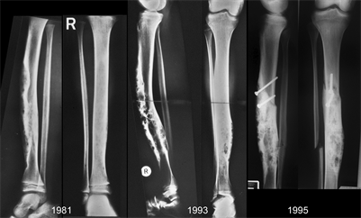 Osteofibrous Dysplasia-Like Adamantinoma of the Tibia Diagnosed at Age ...