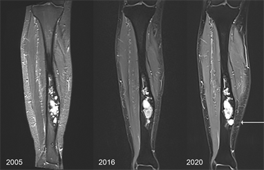 Osteofibrous Dysplasia-Like Adamantinoma of the Tibia Diagnosed at Age ...