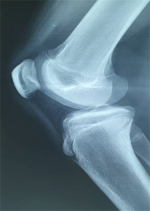 Osgood Schlatter Disease: Study of 2 Observations in Conakry, Guinea