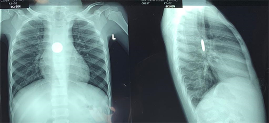 Open Thoracic Surgery for Removal of a Two-Year-Old Impacted Esophageal ...