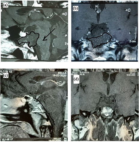 Expanded Endoscopic Endonasal Approach (EEEA) for Clival Chordomas