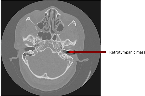 Per-Operative Discovery of Tympanic Paraganglioma: A Case Report