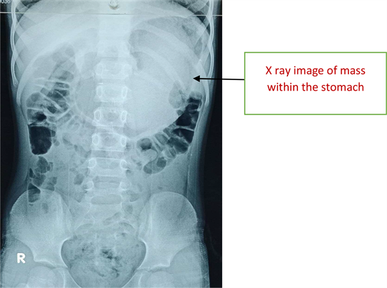 Gastric Trichobezoar, Case Presentations