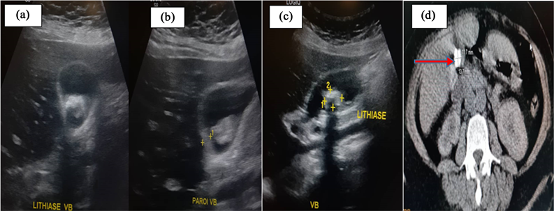 Osler’s Subacute Infective Endocarditis on Rheumatic Heart: A ...