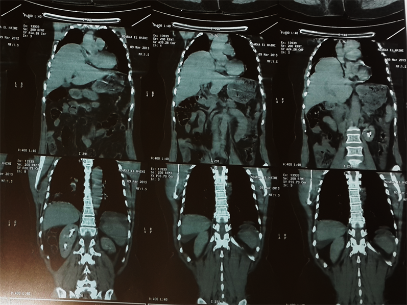 Right Post-Traumatic Diaphragmatic Hernia with Liver Dislocation