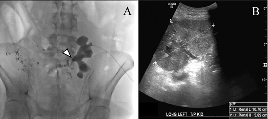 Long Term Management Of Post Transplant Ureteral Stricture With