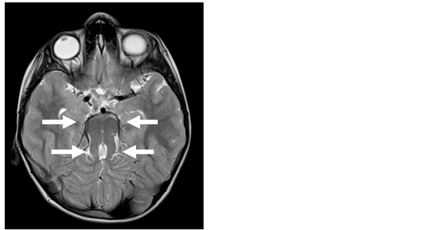 CT and MR Imaging Findings in the Joubert Syndrome, a "Ciliopathy"
