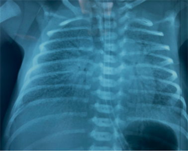 Pantoea SPP: A New Nosocomial Infection in the Neonatal Intensive Care Unit