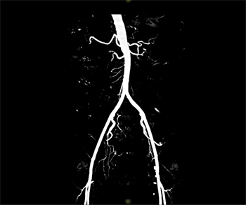 Acute Aortic Occlusion in a Critically Ill Adult Presenting to the ...