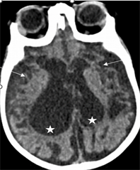 CT Aspects of Psychomotor Delays in Children Aged 0 to 5 Years at ...