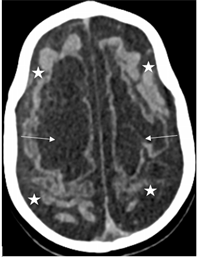 CT Aspects of Psychomotor Delays in Children Aged 0 to 5 Years at ...