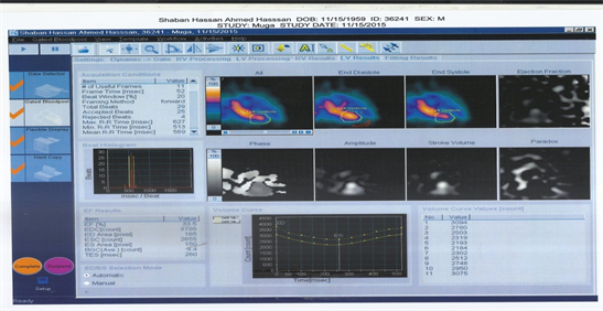 Right Ventricular Dysfunction in Patients with Acute STEMI ...