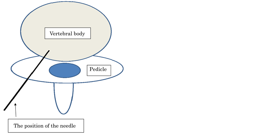 Vertebral Bone Drilling (Puncture) Attenuates the Intractable Pain Due ...