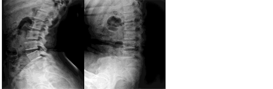 Surgical Management of Spondylolisthesis by Pedicular Screw Rod System ...