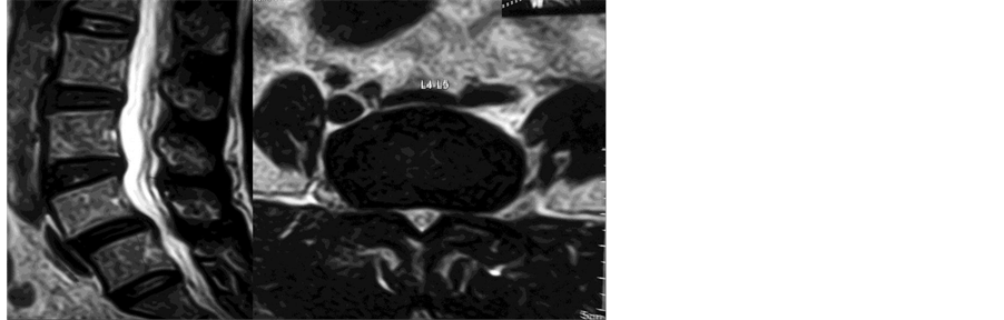 Surgical Management of Spondylolisthesis by Pedicular Screw Rod System ...