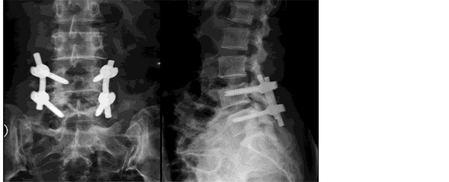 Surgical Management of Spondylolisthesis by Pedicular Screw Rod System ...