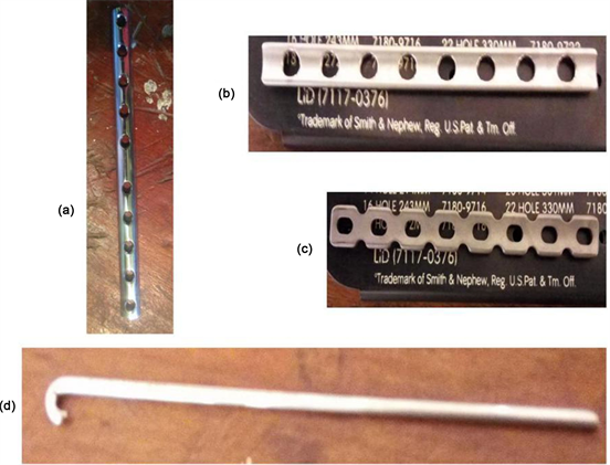 Exclusive Fibula Osteosynthesis for Treating Open Fractures Gustillo I ...
