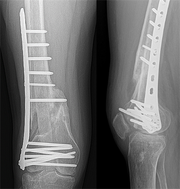 The Use of Autologous Tibia Strut Graft to Enhance Bone Healing of an ...