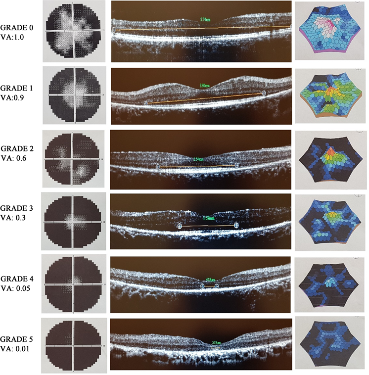 A New Classification for Retinitis Pigmentosa Including Multifocal ...