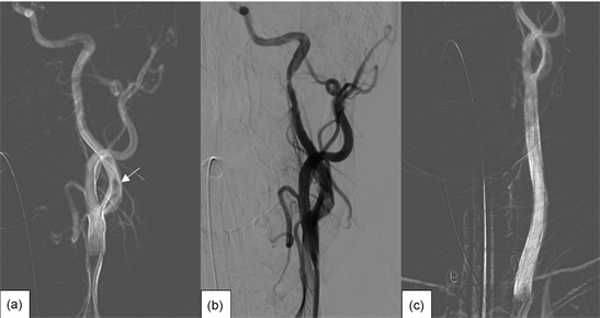 Ischemic Stroke Secondary to Dissection of the Internal Carotid Artery ...