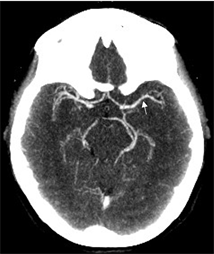 Ischemic Stroke Secondary to Dissection of the Internal Carotid Artery ...