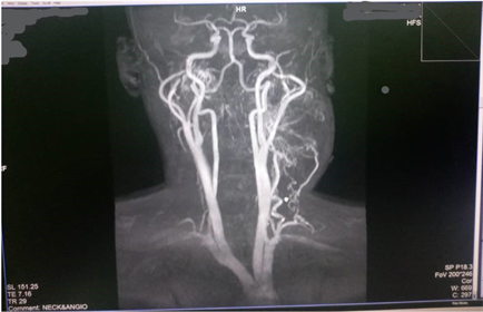 Anaesthetic Management and Challenges for Carotid Body Tumour Excision ...