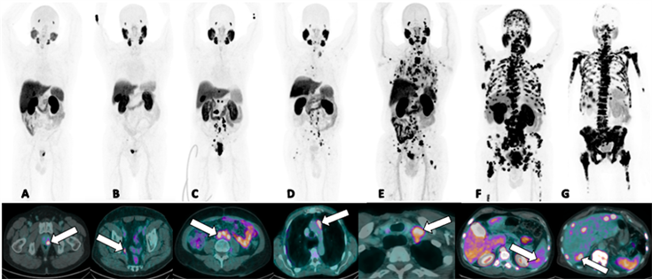 PET/CT with 18 F-PSMA in Patients with Prostate Cancer, Review of the ...