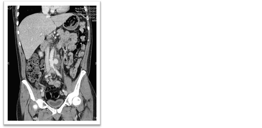Mycotic Aneurysm of Infrarenal Aorta: A Case Report and Review of ...