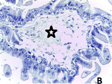 Bilateral Tubal Molar and Embryonic Pregnancy