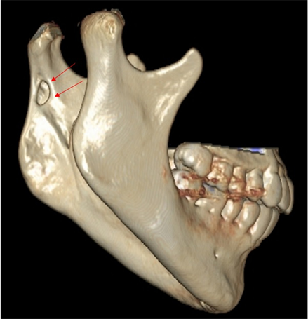 Stafne’s Bone Defect in Atypical Location: Between the Subcondylar ...