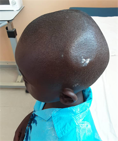 Practice of Pediatric Neurosurgery at the “Hôpital Spécialisé Mère ...