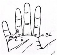 Modified Z-Plasty for Reconstruction of Webbed Scar Contractures