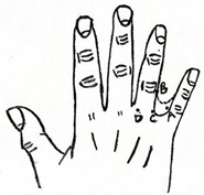 Modified Z-Plasty for Reconstruction of Webbed Scar Contractures