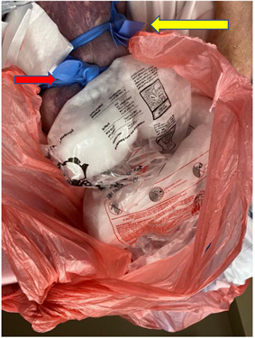 Is the Critical Patient with a Septic Limb Too Sick for an Emergent ...