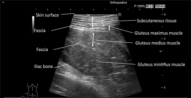 Intramuscular Injection Sites Gluteal Injection Technique 1: