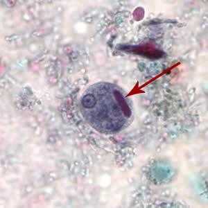 Different Detection and Treatment Methods for Entamoeba histolytica and ...