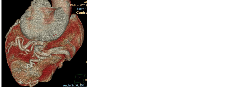 Adult ALCAPA Syndrome-Anomalous Origin of Left Coronary Artery from ...