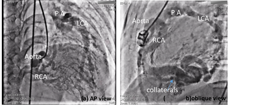 Adult ALCAPA Syndrome-Anomalous Origin of Left Coronary Artery from ...