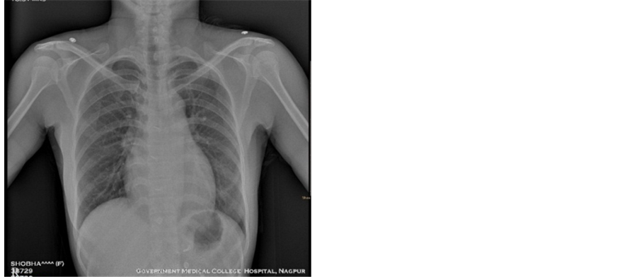 Adult ALCAPA Syndrome-Anomalous Origin of Left Coronary Artery from ...