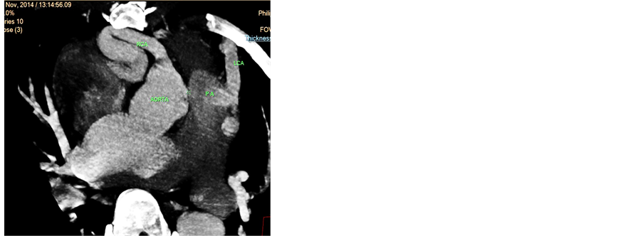 Adult ALCAPA Syndrome-Anomalous Origin of Left Coronary Artery from ...